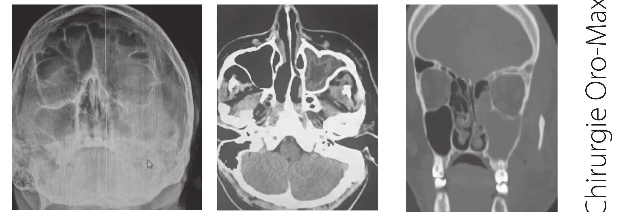Radiografia sinusurilor maxilare, tc incidenta axiala si