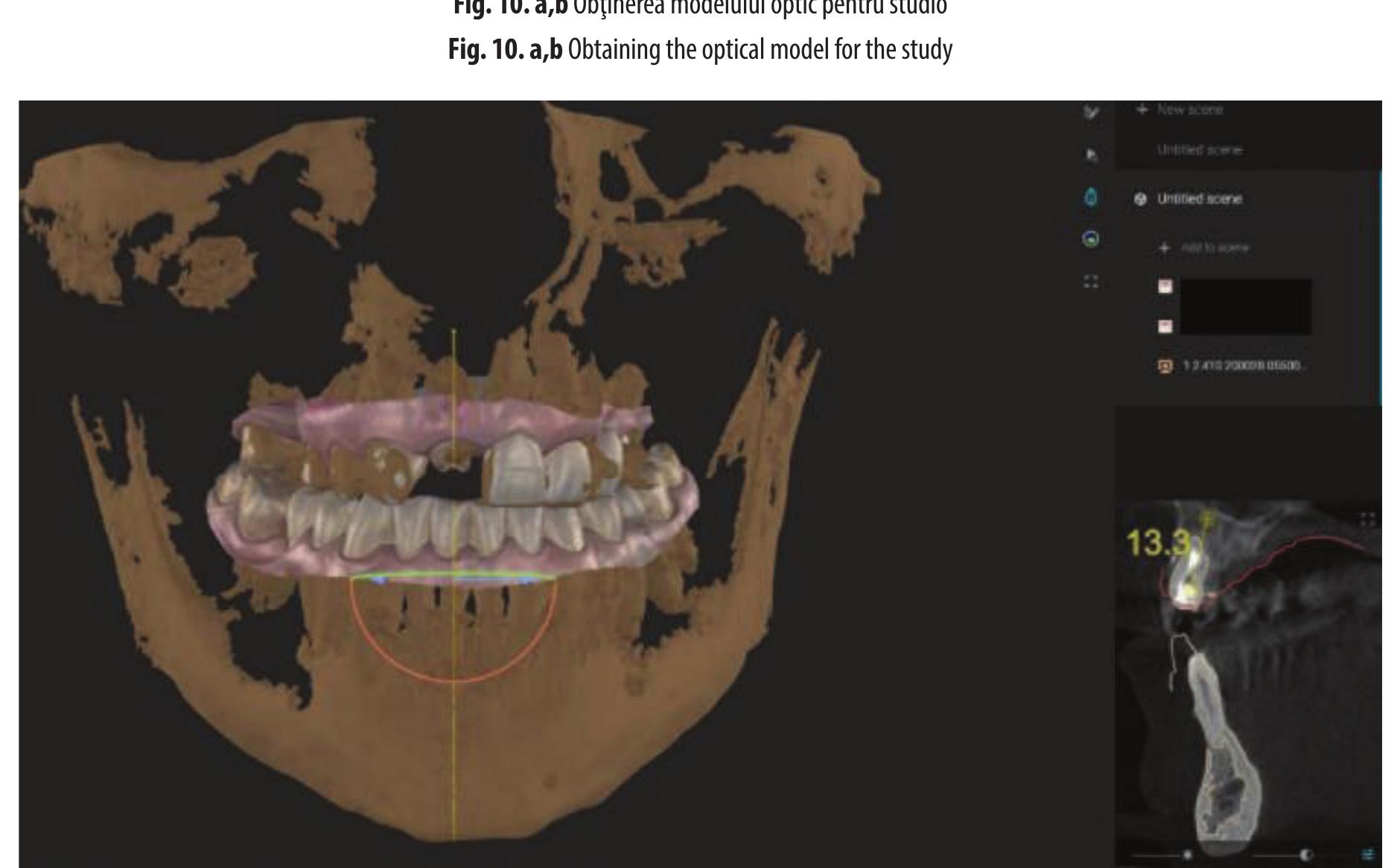 Suprapunerea amprentei optice si cbct pentru aprecierea