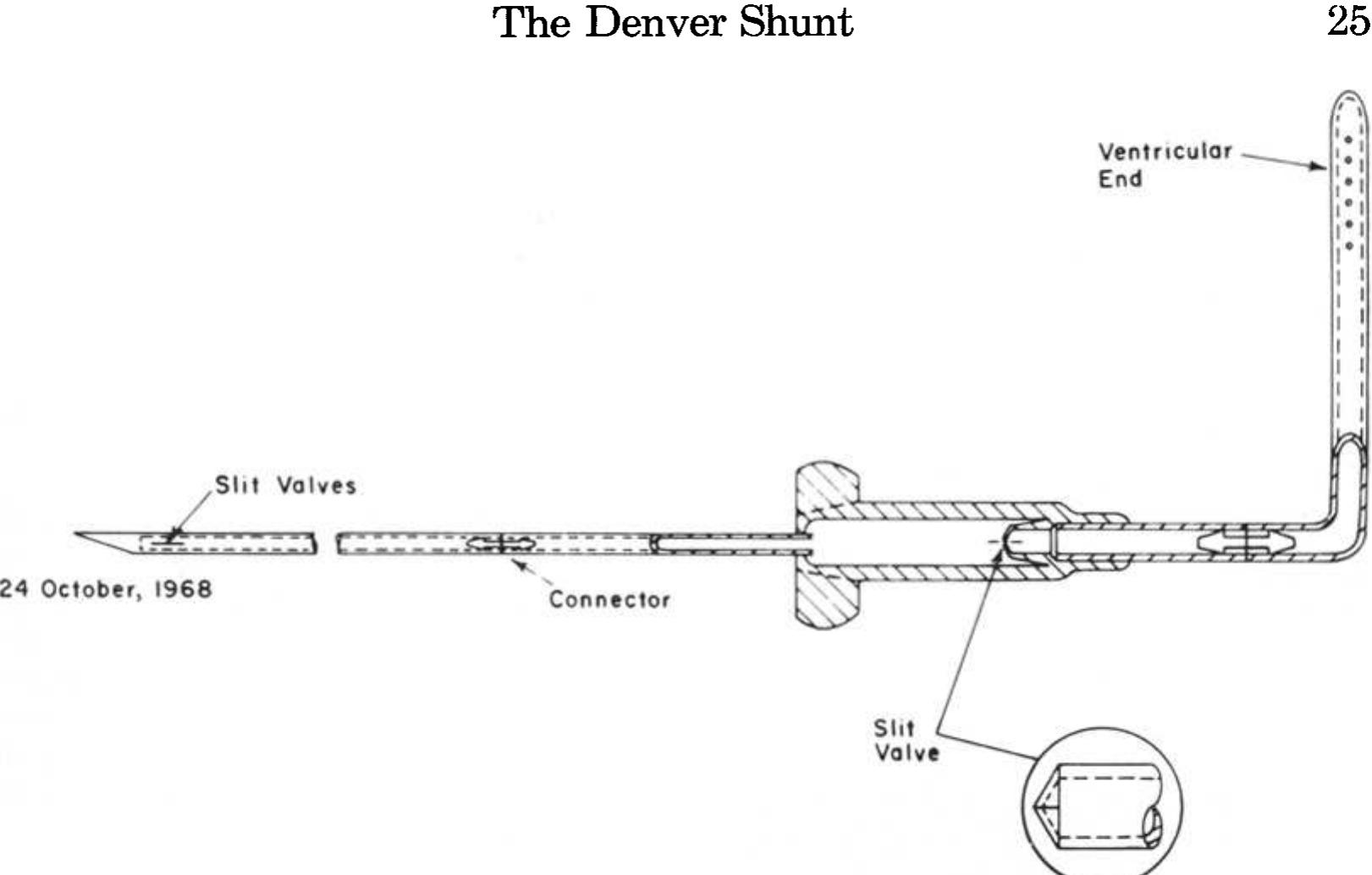 Fic. 1. diagram of denver hydrocephalus shunt. note attitude
