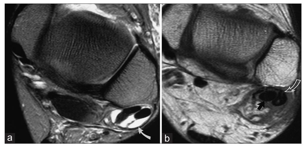 Peroneal tendinopathy. (a) peroneal tenosynovitis. (b)