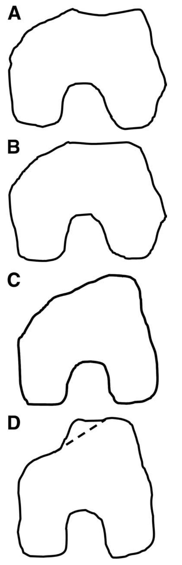 Ficure 1. classification of trochlear dysplasia (data from