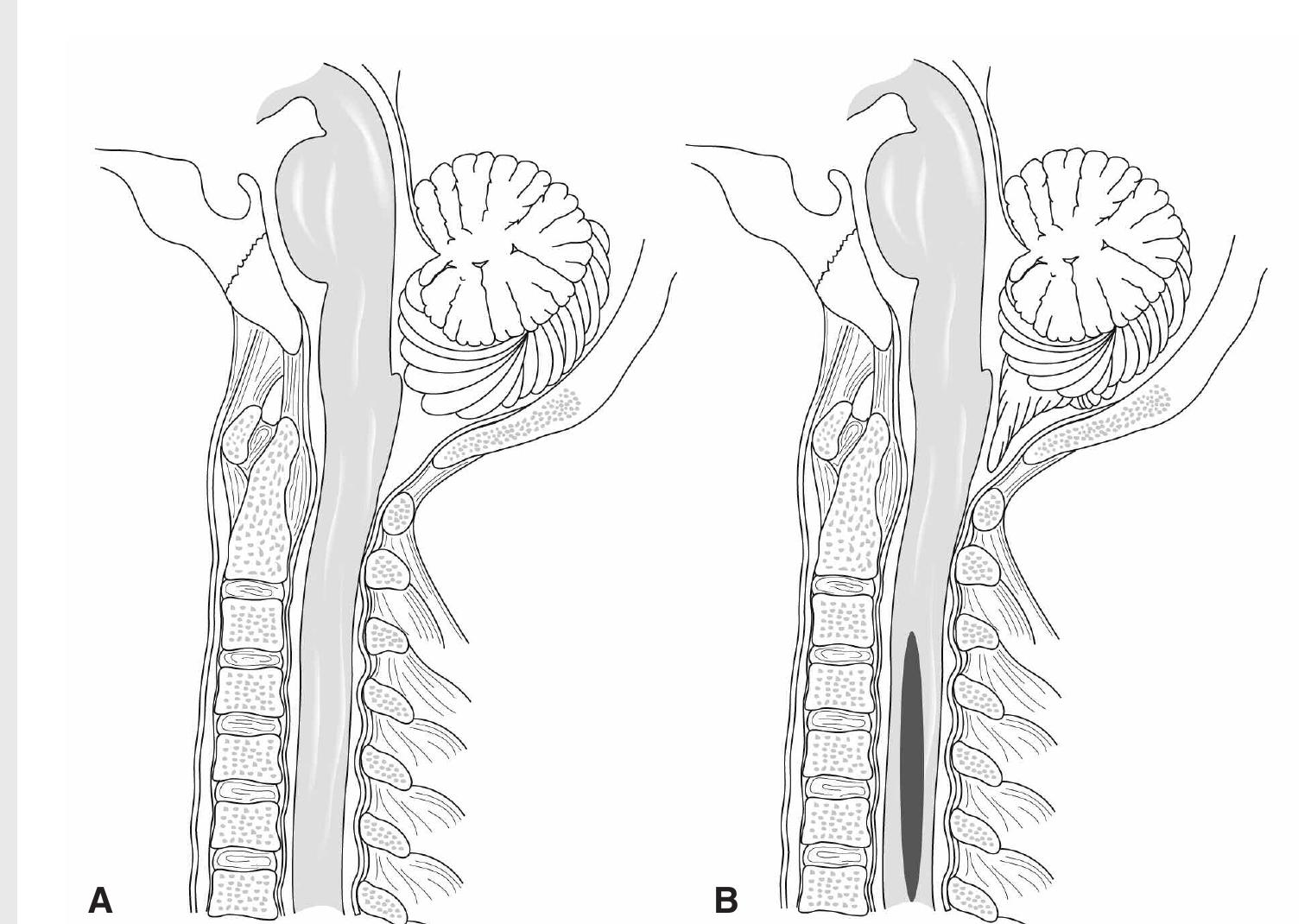 Schematic representation showing normal anatomy of