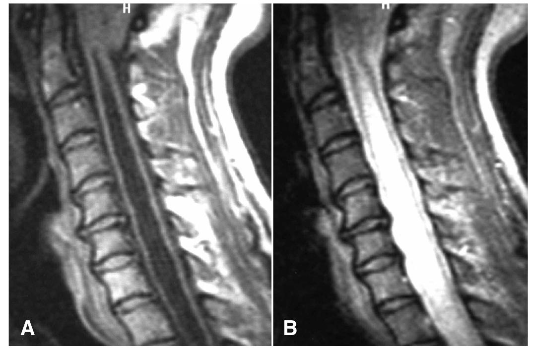 Sagittal mri scans in a patient with type i chiari mal-
