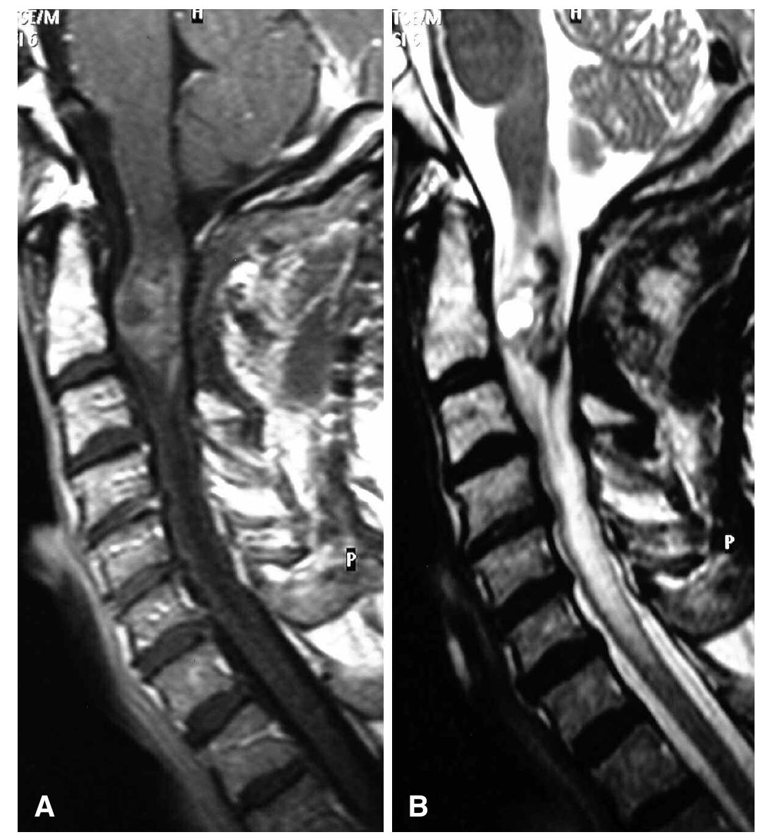 Sagittal mri scans showing a cystic spinal cord tumor