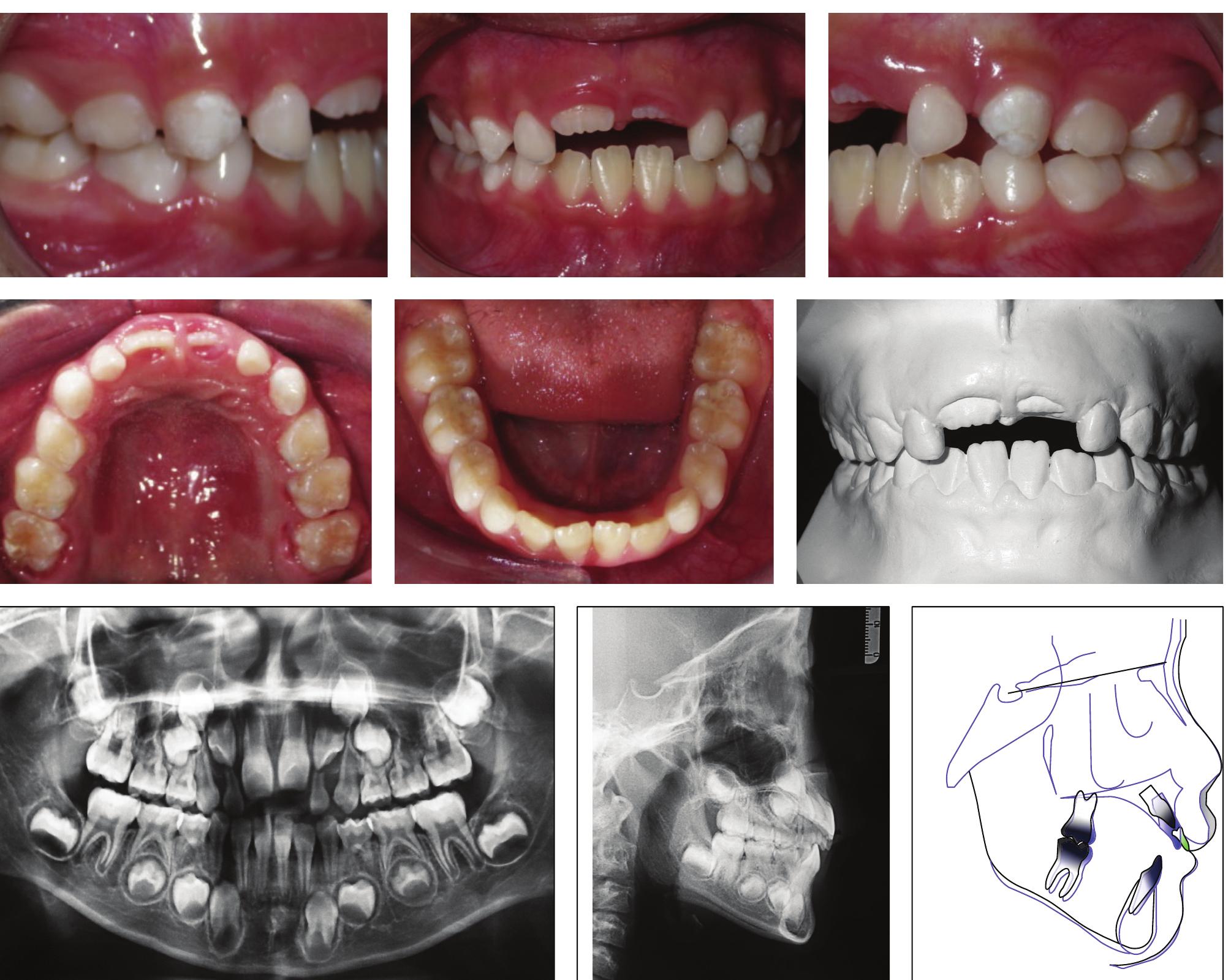 Postexpansion intraoral photographs, radiographs, and