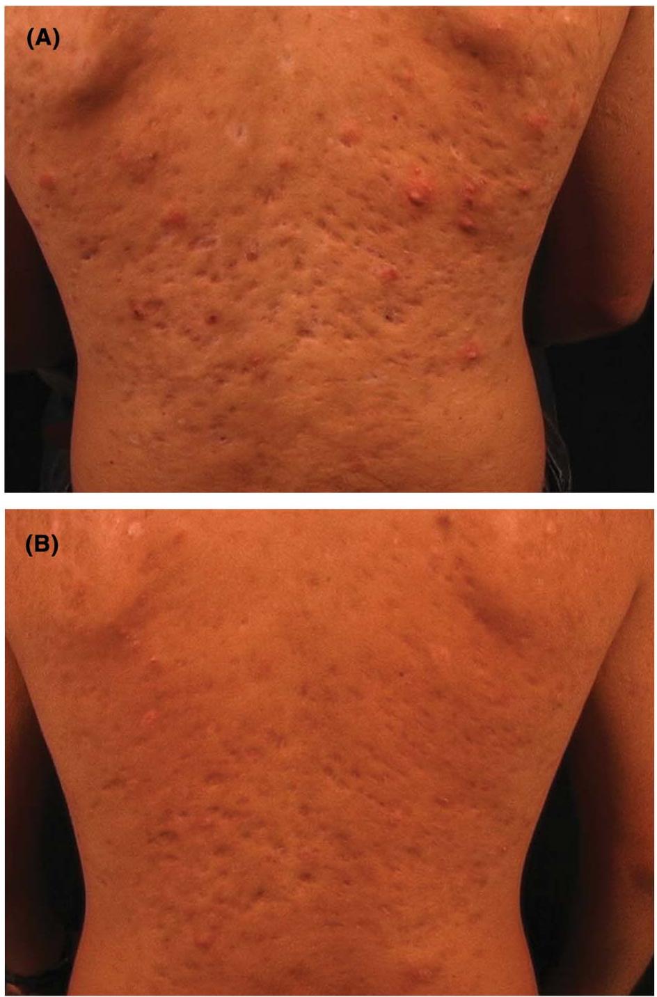 Atrophic acne scars on the back before (a) and 1 month after