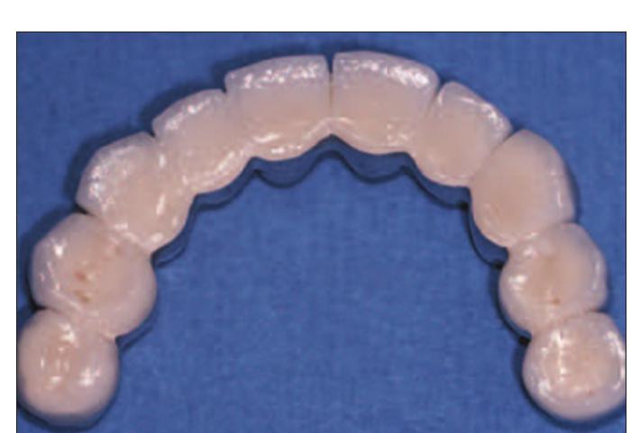Occlusal view of the final bridge show- ing the functional