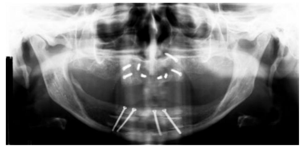 Uniform augmentation both in anterior and posterior region