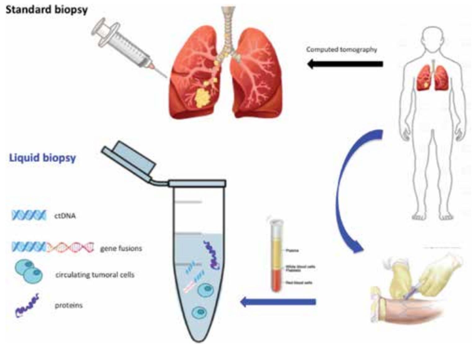 Standard biopsy versus liquid biopsy. the figure illustrates