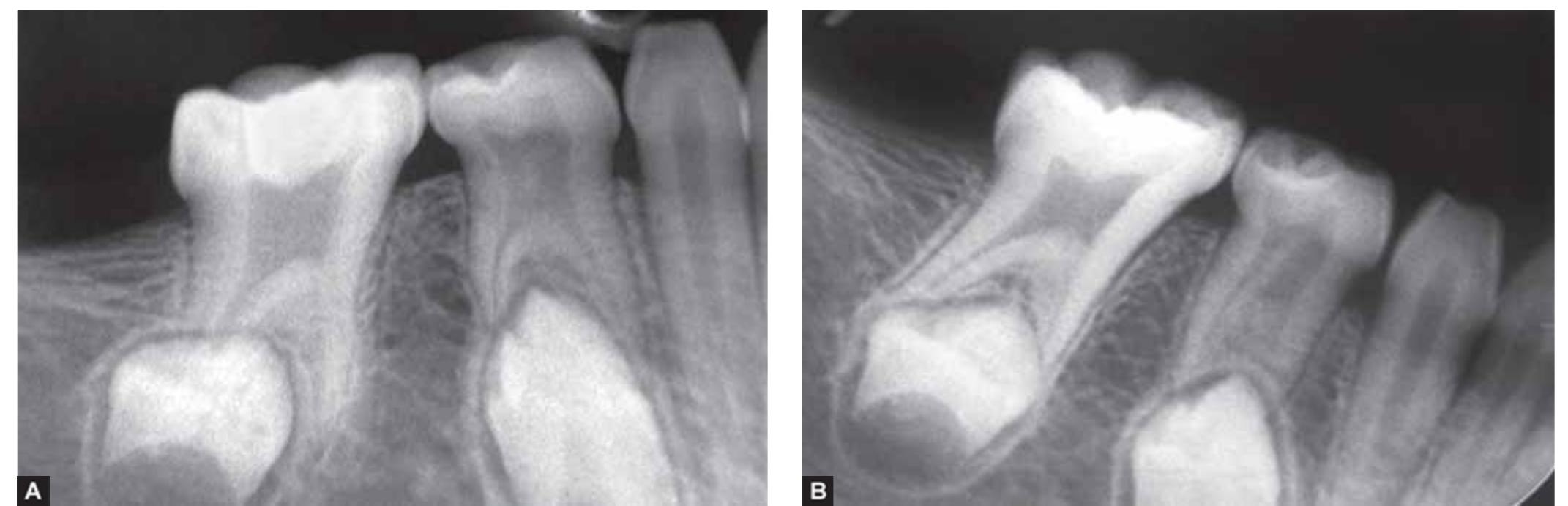 S 3a and b: intraoral periapical radiograph (lopa) showing