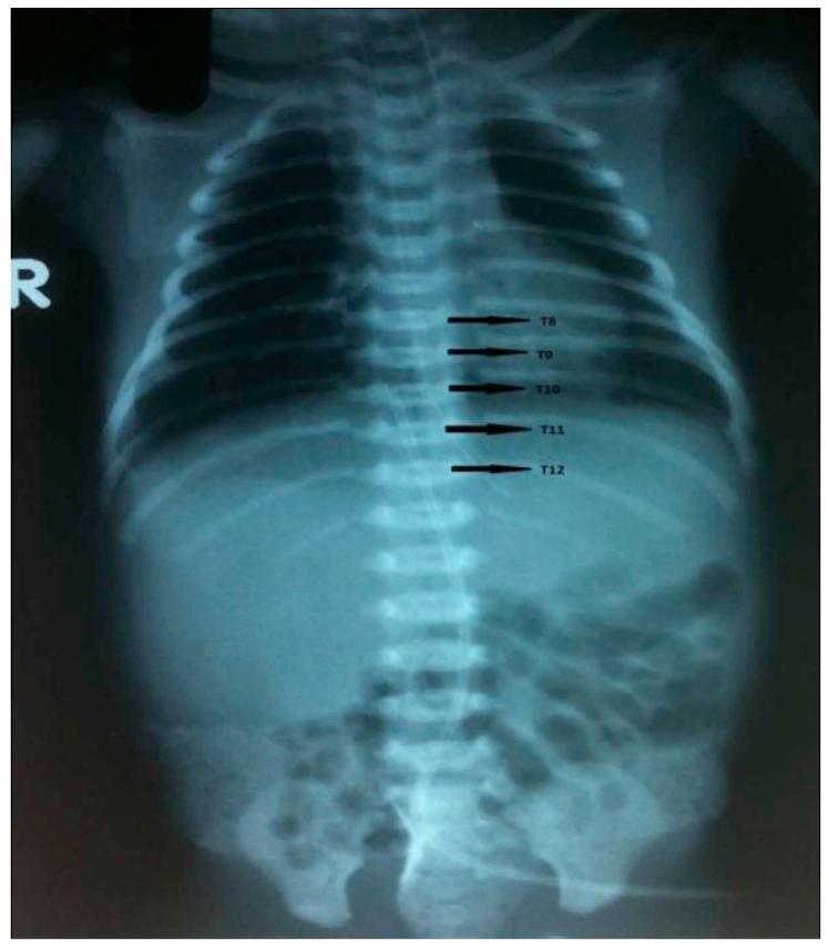 Chest radiograph showing correct position of uvc tip.