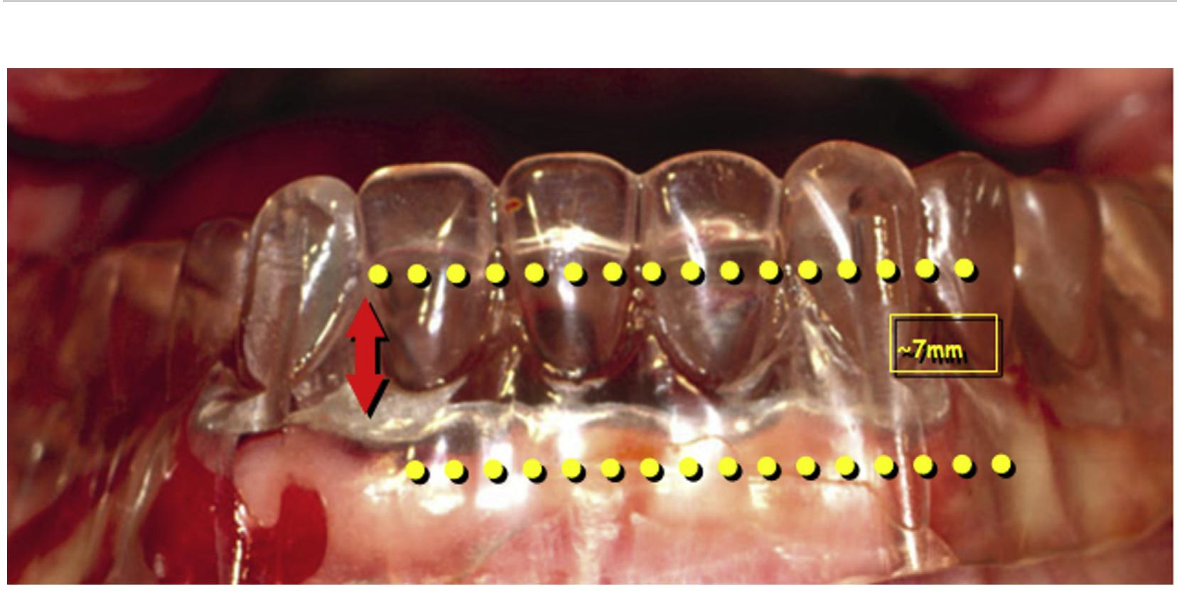 Surgical guide demonstrating restorative space needed for