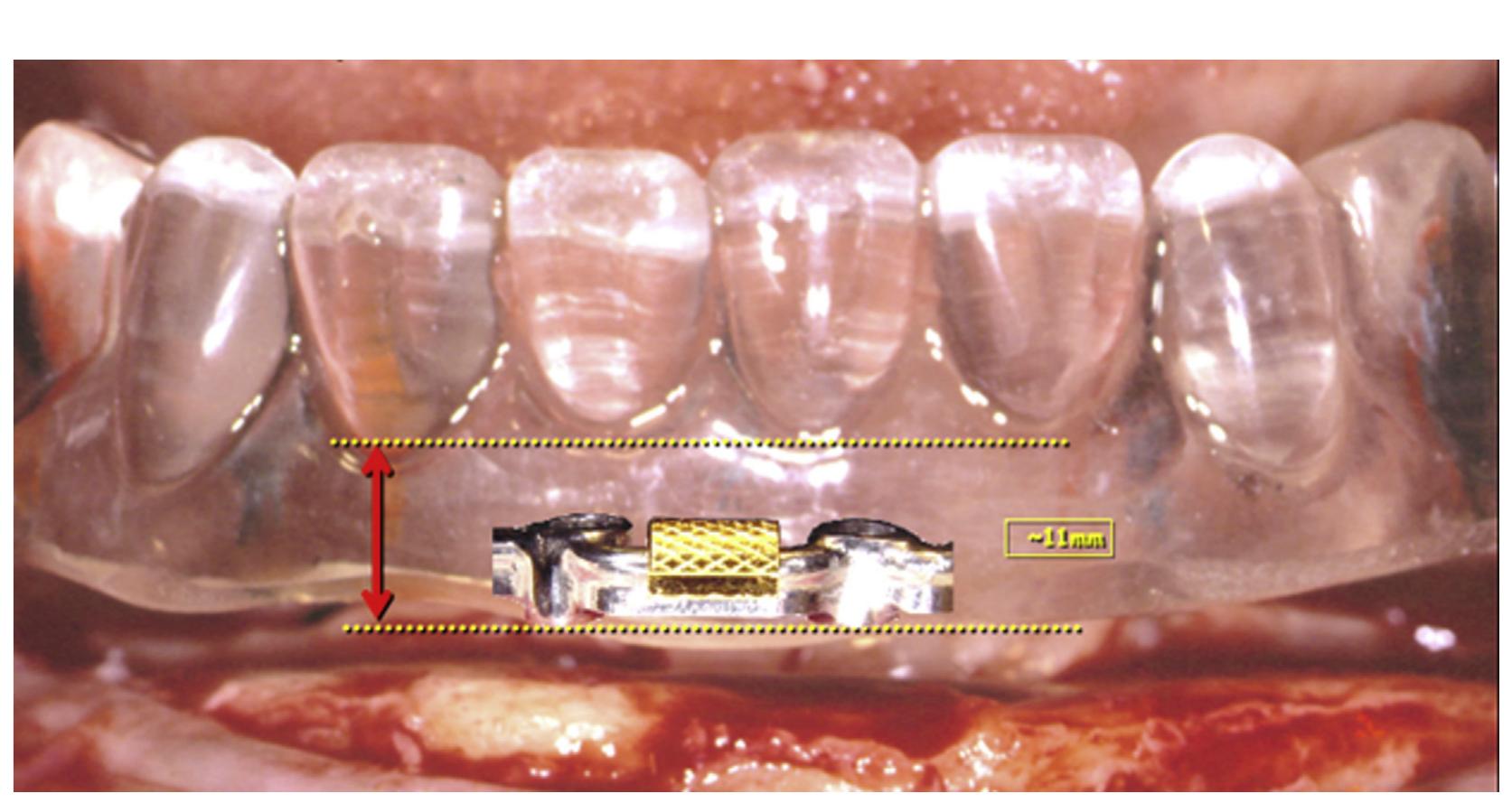 Splinted bar mandibular overdenture. the minimal vertical