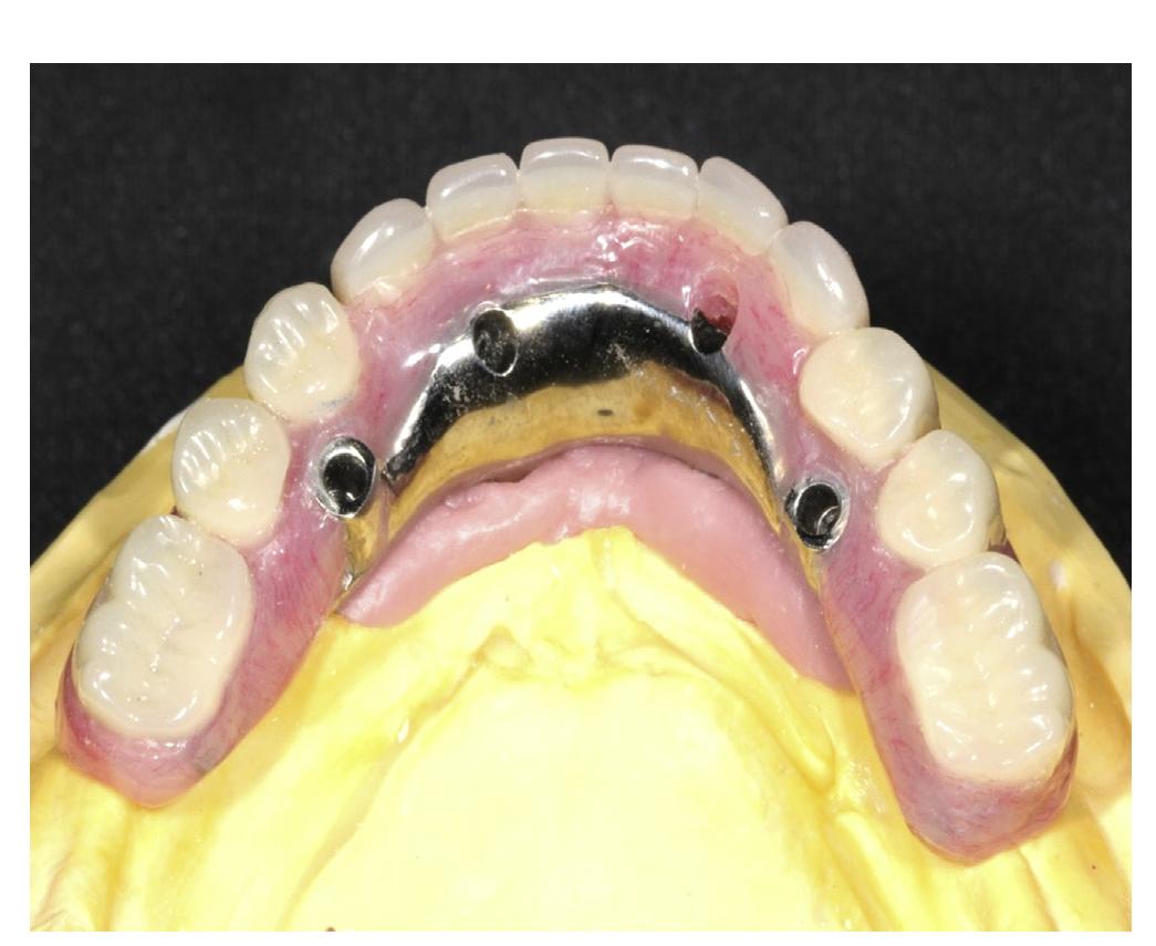 Screw-retained hybrid prosthesis spanning teeth nos. 19
