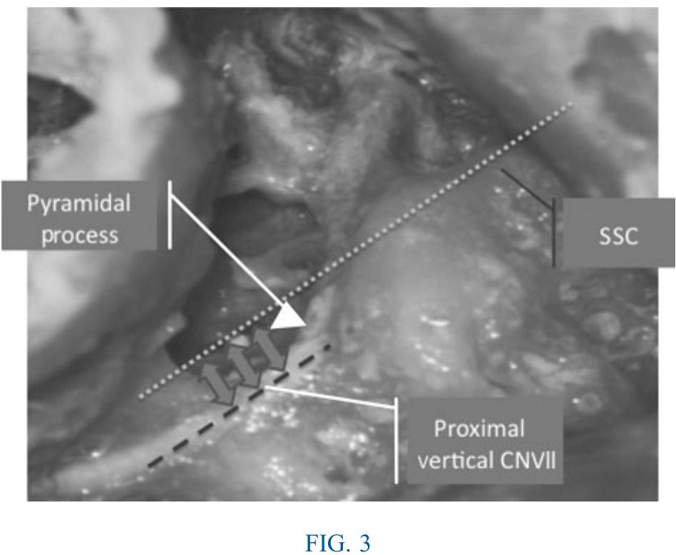 Simple method to identify the anterior border of the