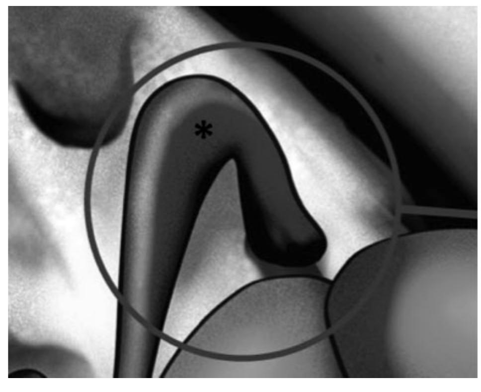 Diagram of the anterior supralabyrinthine triangle (left