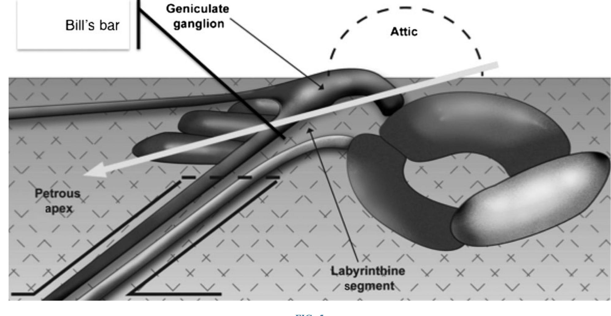 Diagram of anterior supralabyrinthine air cell tract