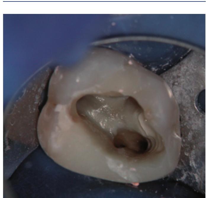 Completed access cavity showing four canal orifices