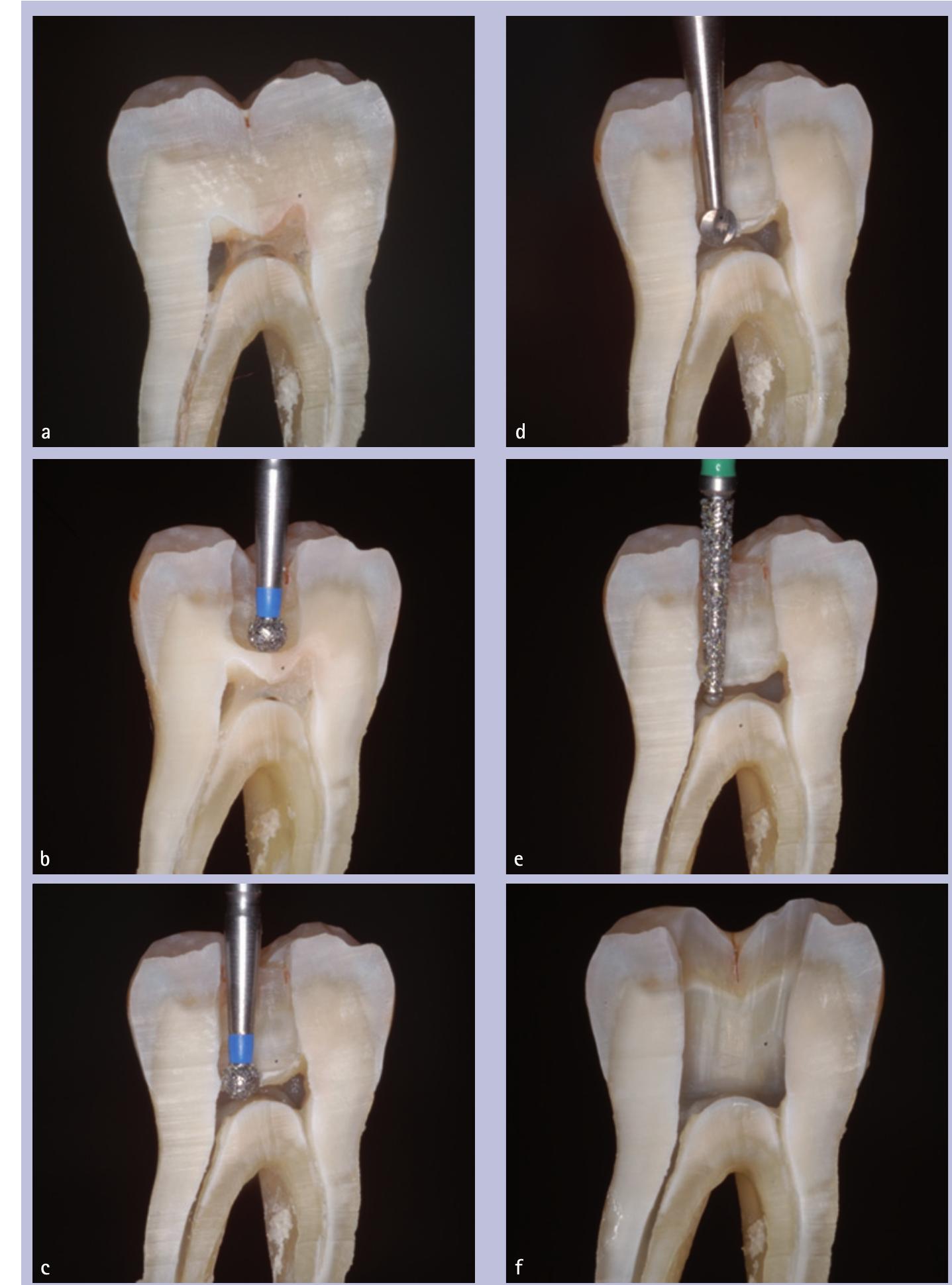 Access cavity preparation in a extracted tooth sectioned in