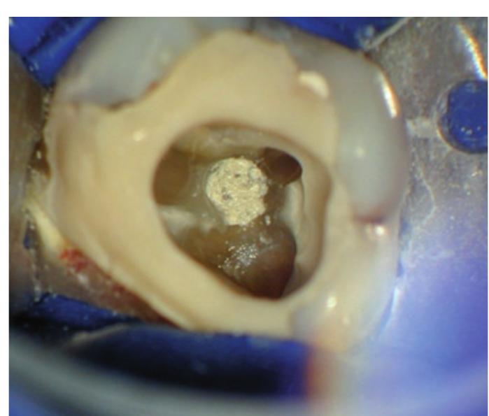 B repair of the perforation with mta and the located root
