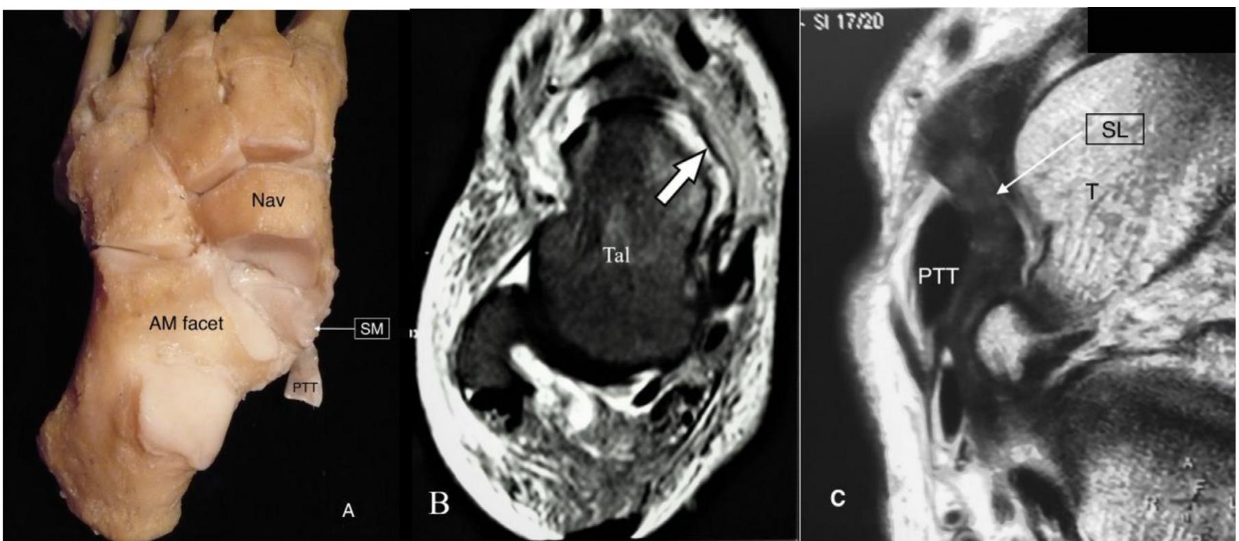 Superomedial calcaneo navicular ligament. (a) anatomic