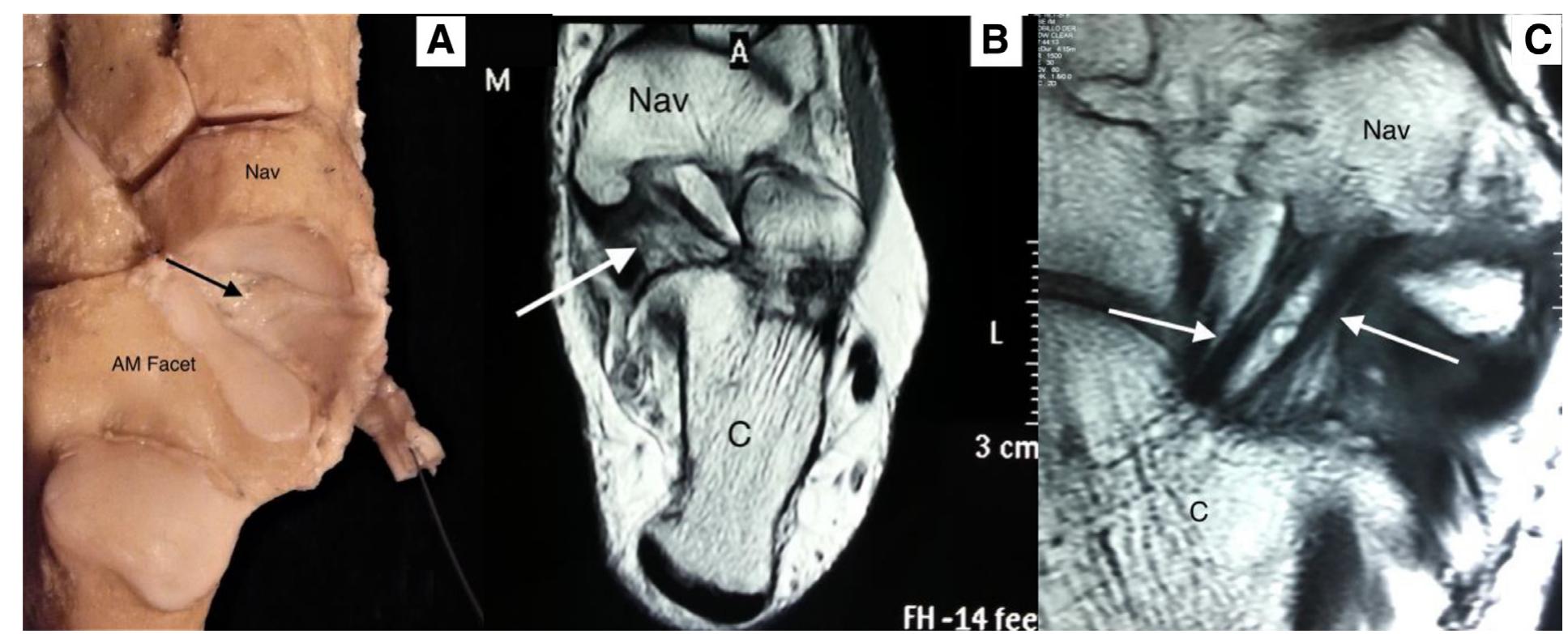 Inferior calcaneonavicular ligament. (a) anatomic dissection
