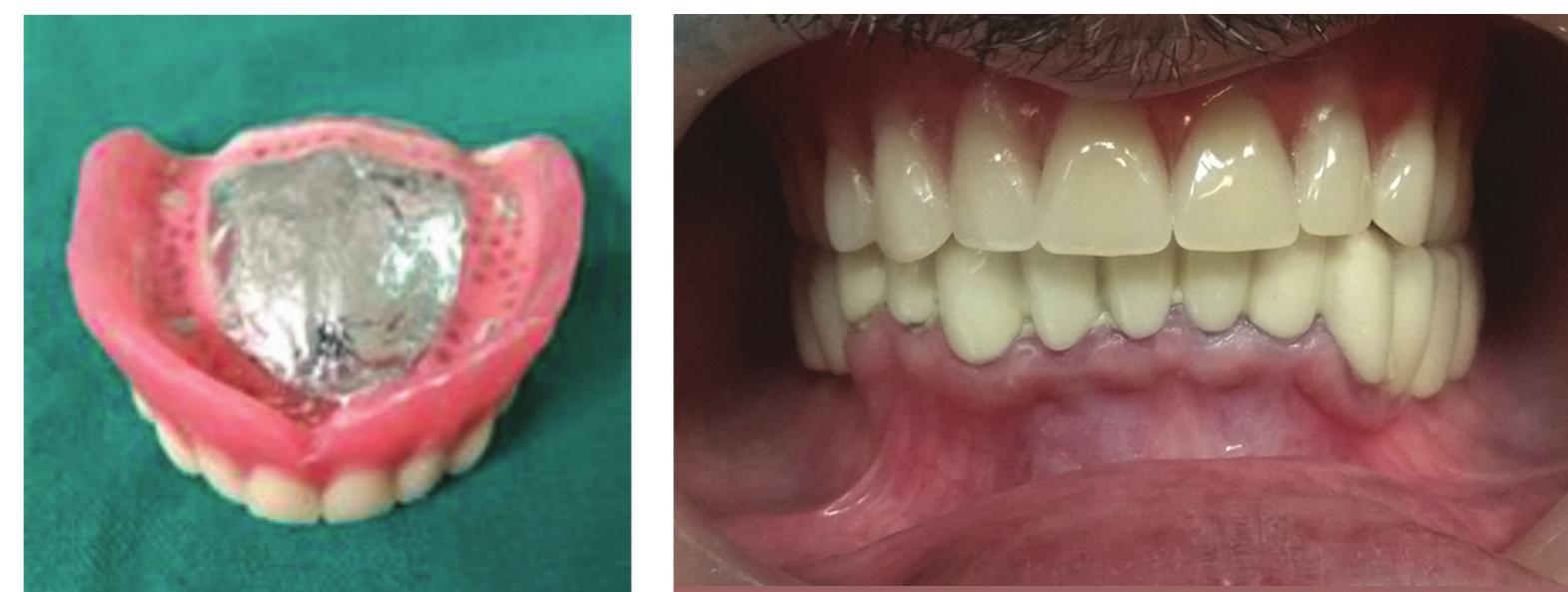 (PDF) Prosthodontic Management of Single Complete Denture with ...