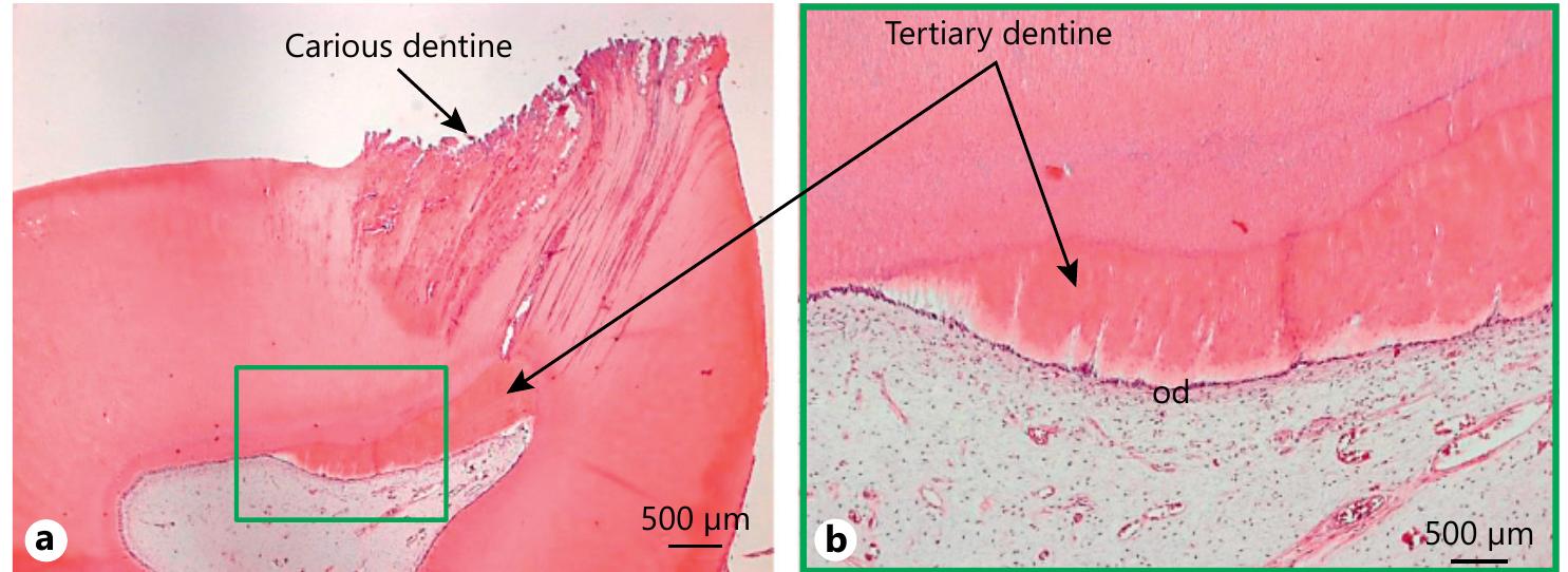 A histology of a moderate carious lesion in a molar. it is