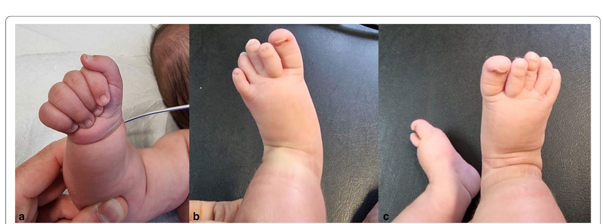 A adducted thumb. b and c bilateral calcaneovalgus talipes,