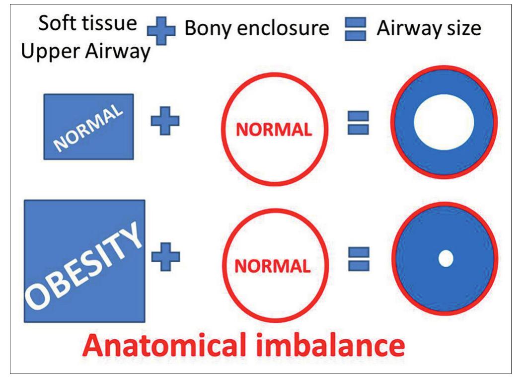 Excessive soft tissue (obesity) in fix bony enclosure leads