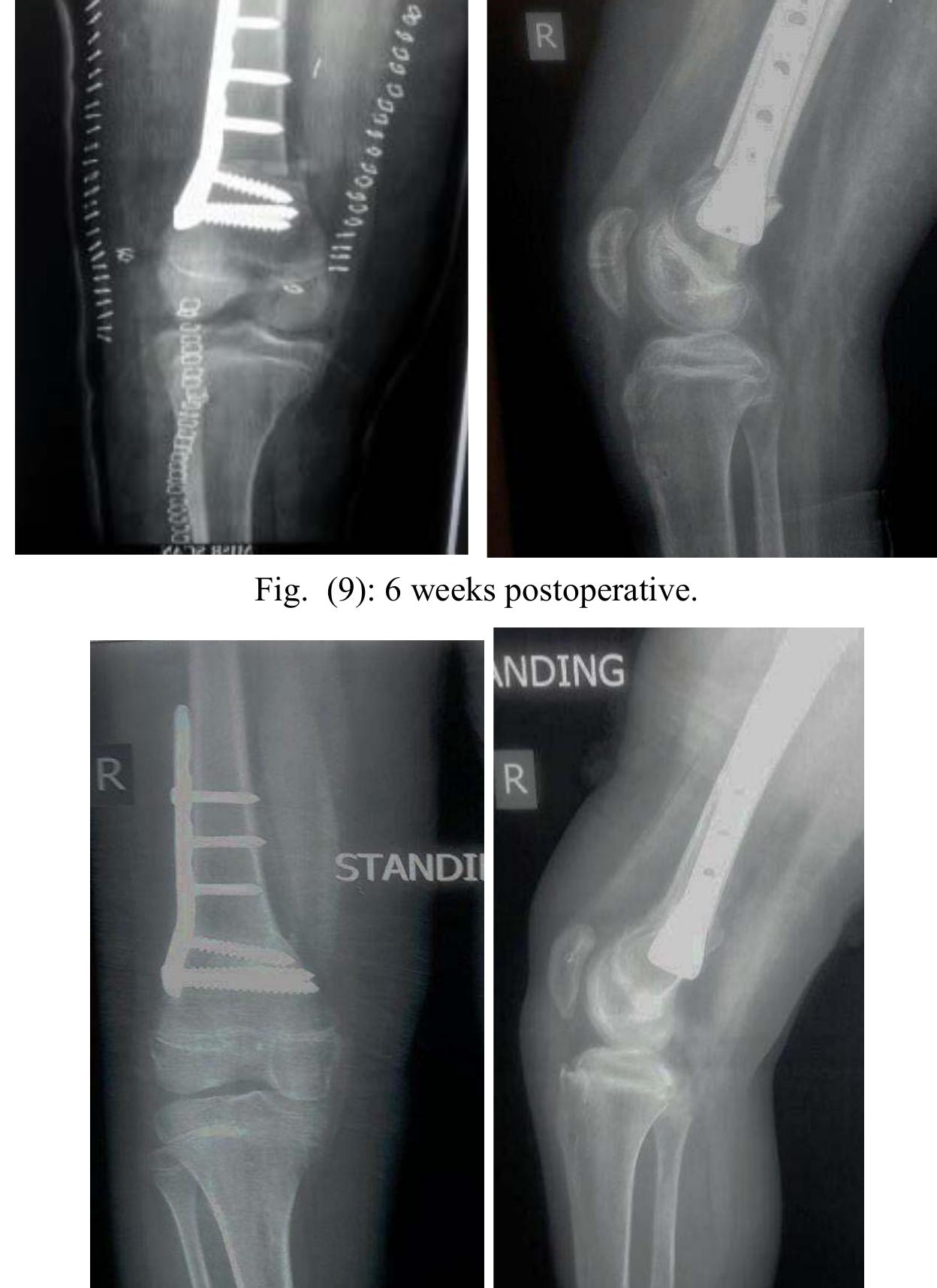 Figure 12 - Supra Condylar Femoral Extension Osteotomy with