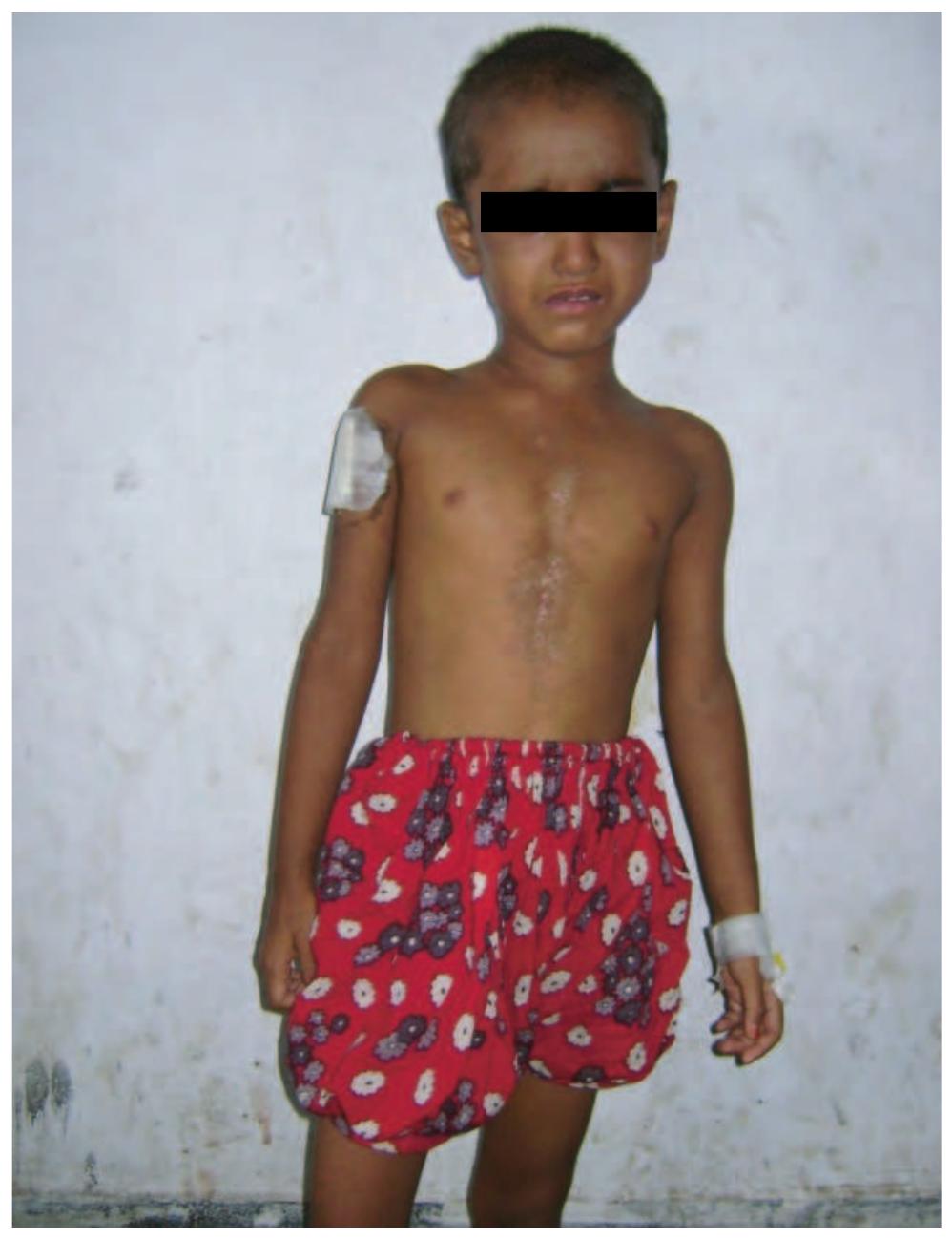 I: five years old girl presented with skin rash on different