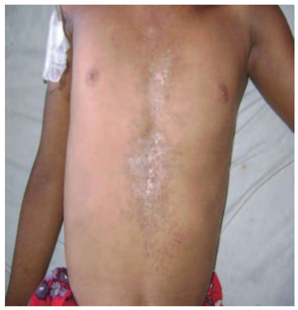 Figure 4 - from Juvenile Dermatomyositis - A Case Report