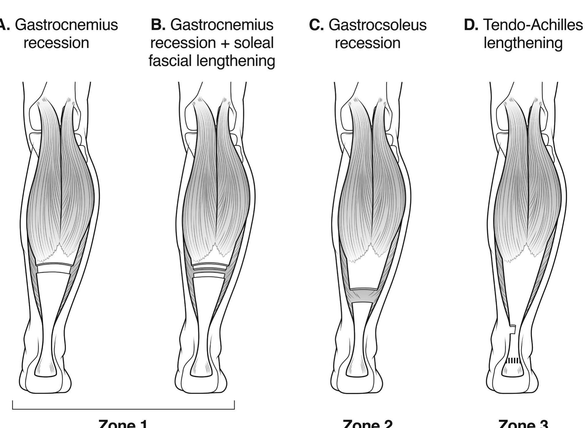 Surgical anatomy of the gastrocsoleus muscle-tendon unit.