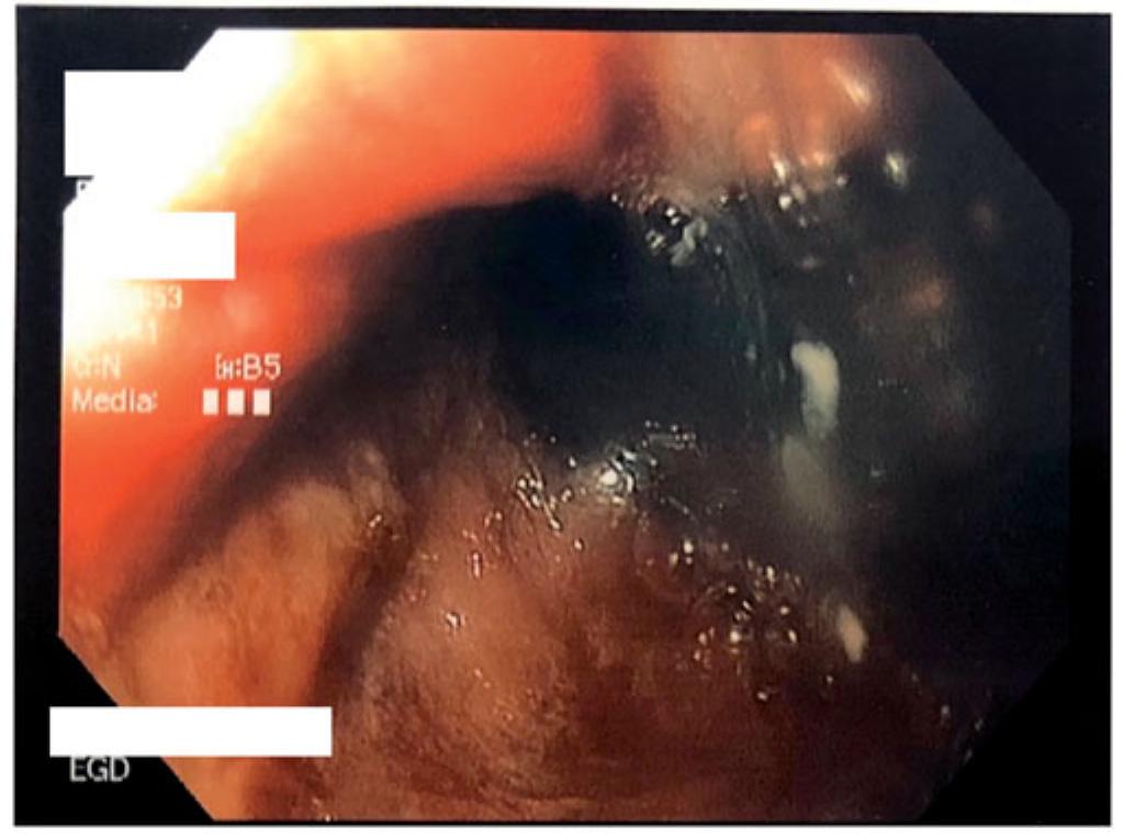 Distal esophagus showing erosive esophagitis and mucosal