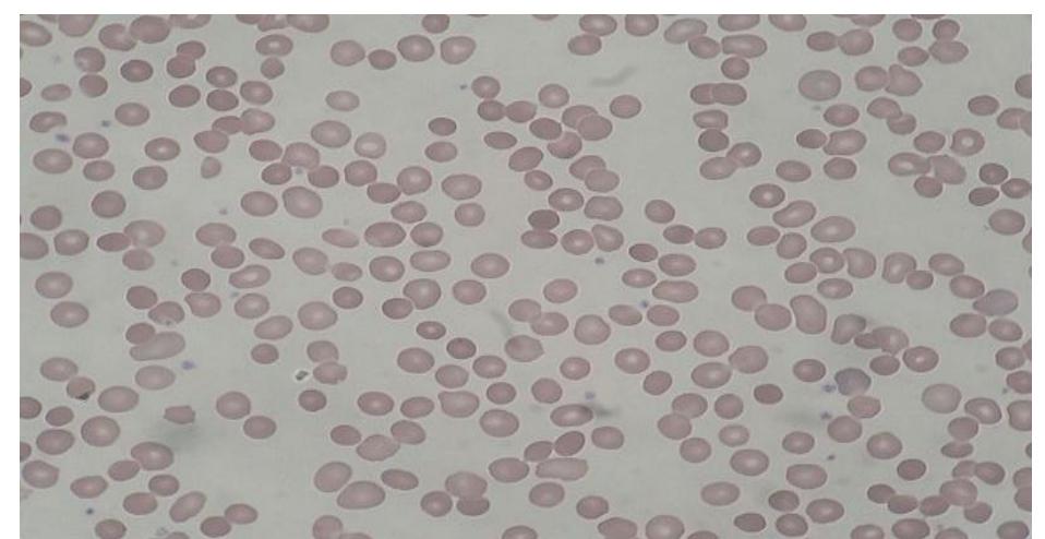 -1: abnormal peripheral blood smears of the patient