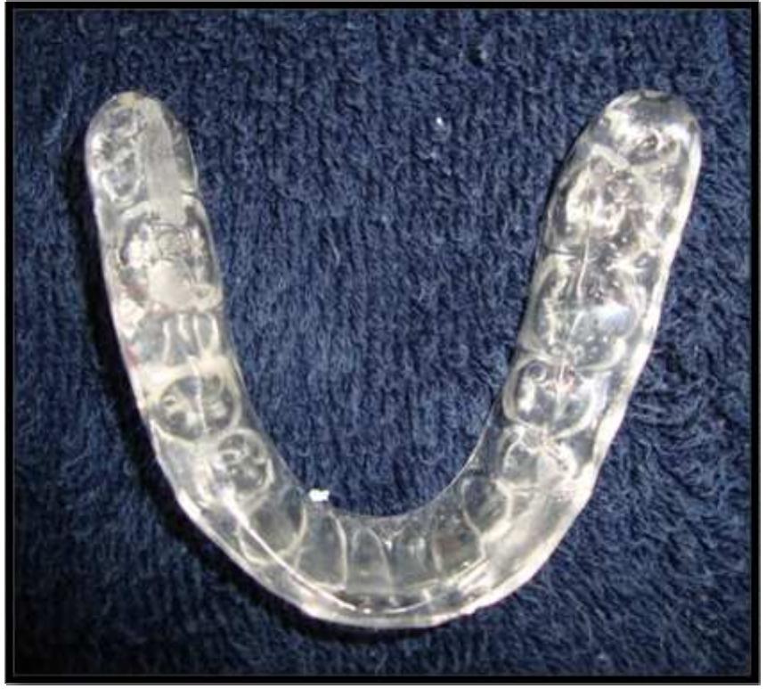 A full arch mandibular plane occlusal splint (stabilization