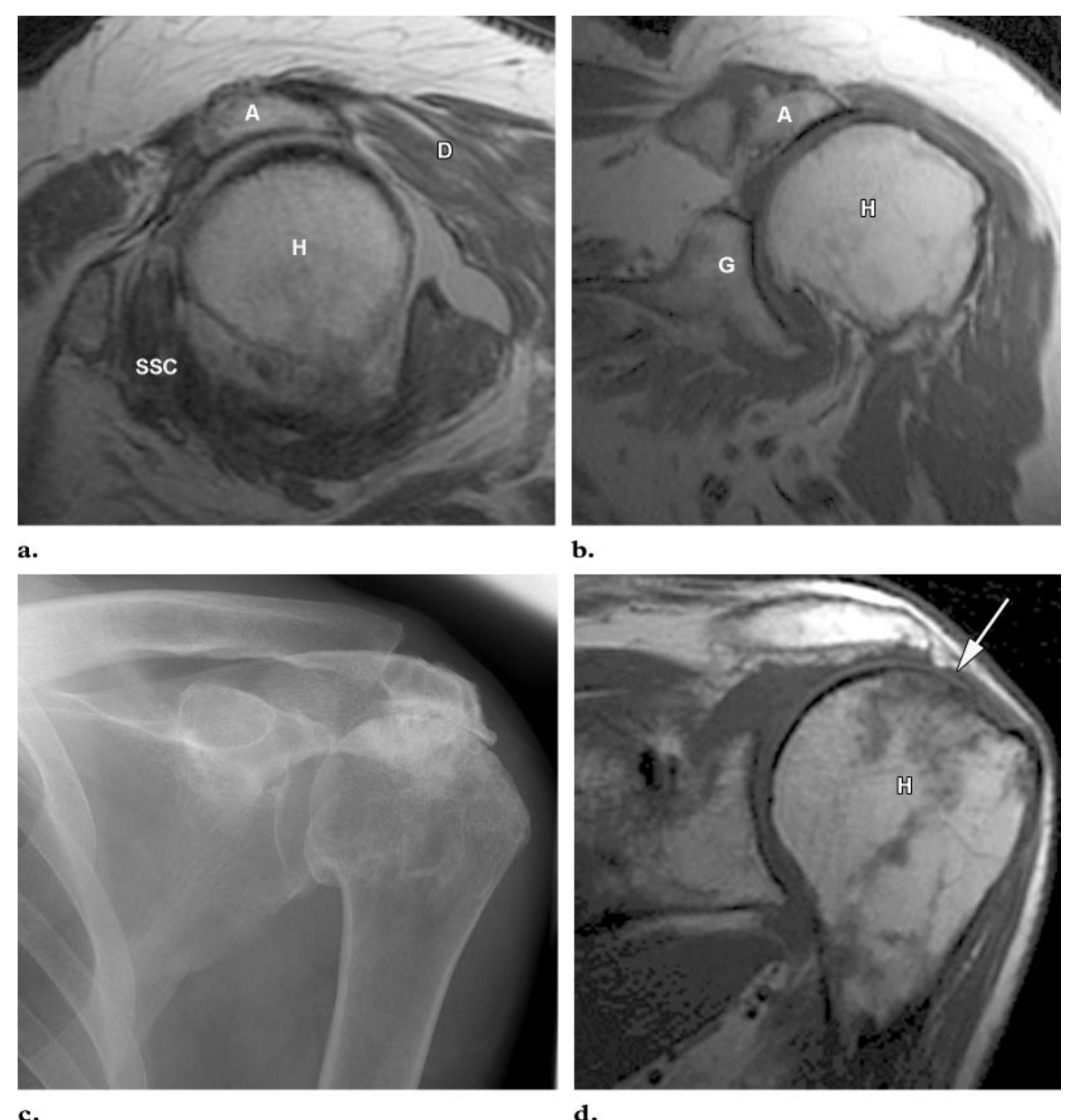 Rotator cuff arthropathy. (a) sagittal t1-weighted mr image
