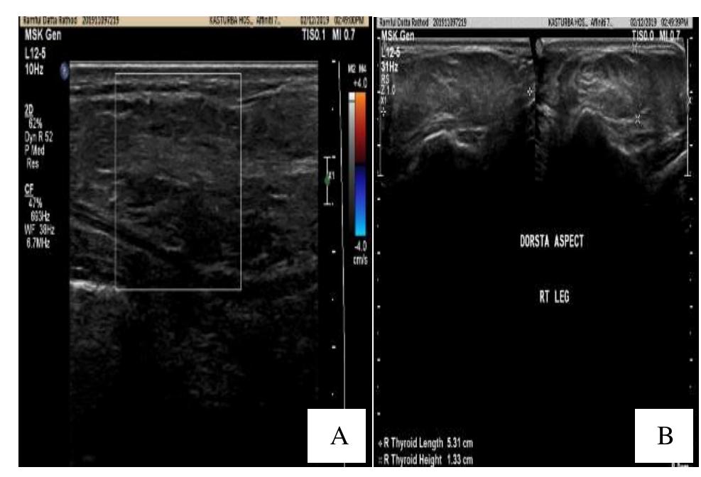 (a and b): pre op and post op x-ray. figure 2(a and b): usg