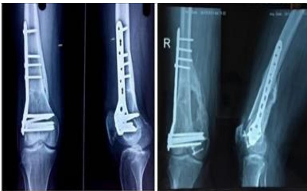 Postoperative radiograph