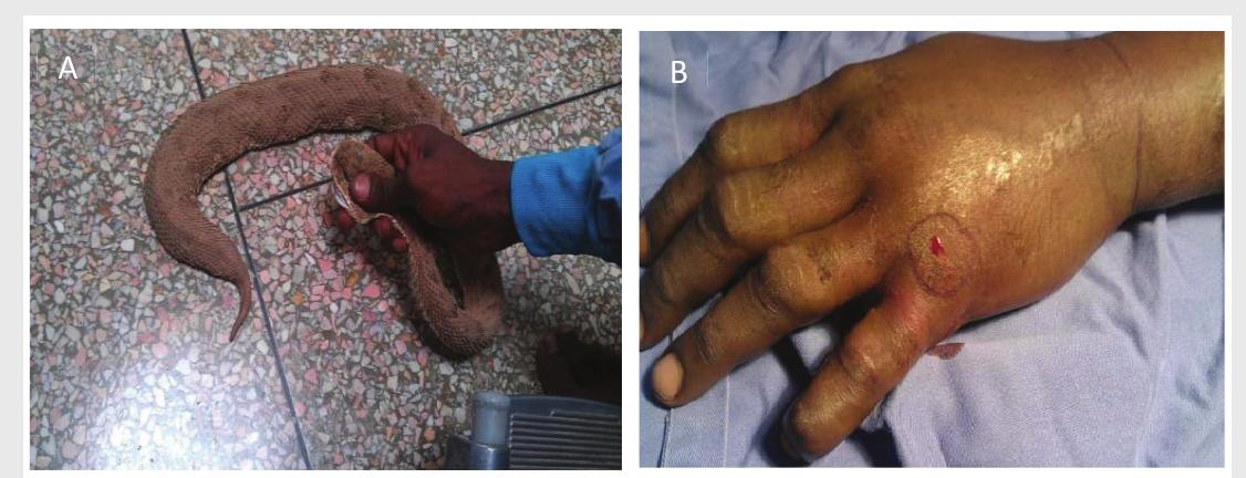 Bitis arietans viper. b: envenomation of snake charmer by