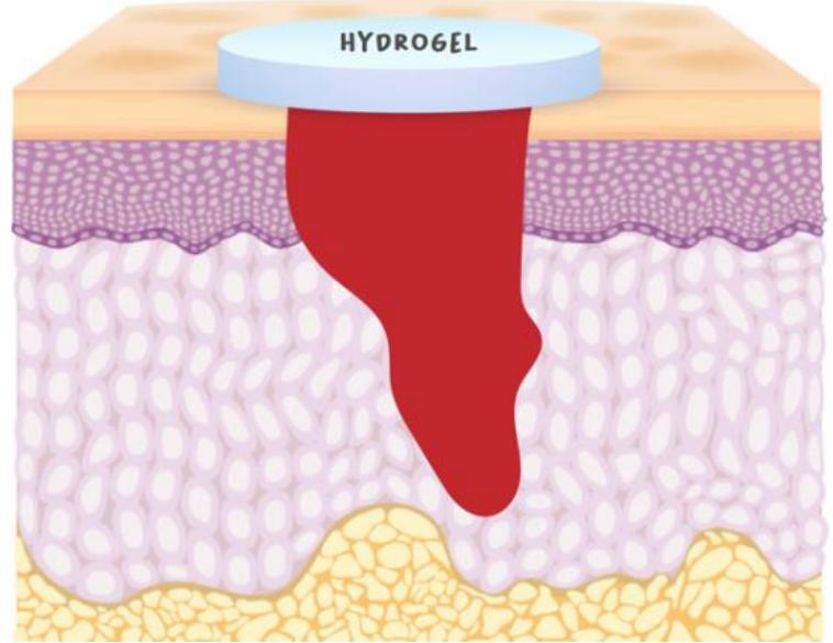 (PDF) PATCHES FOR ACNE TREATMENT: AN UPDATE ON THE FORMULATION AND ...