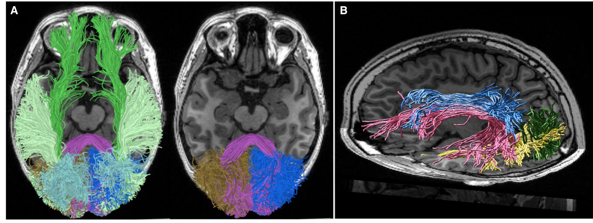 Pathways of vision and reading (a) major tracts with one