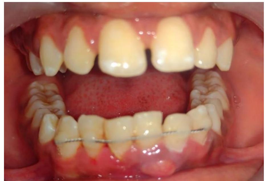 Immediate post op (labial composite wire splint)