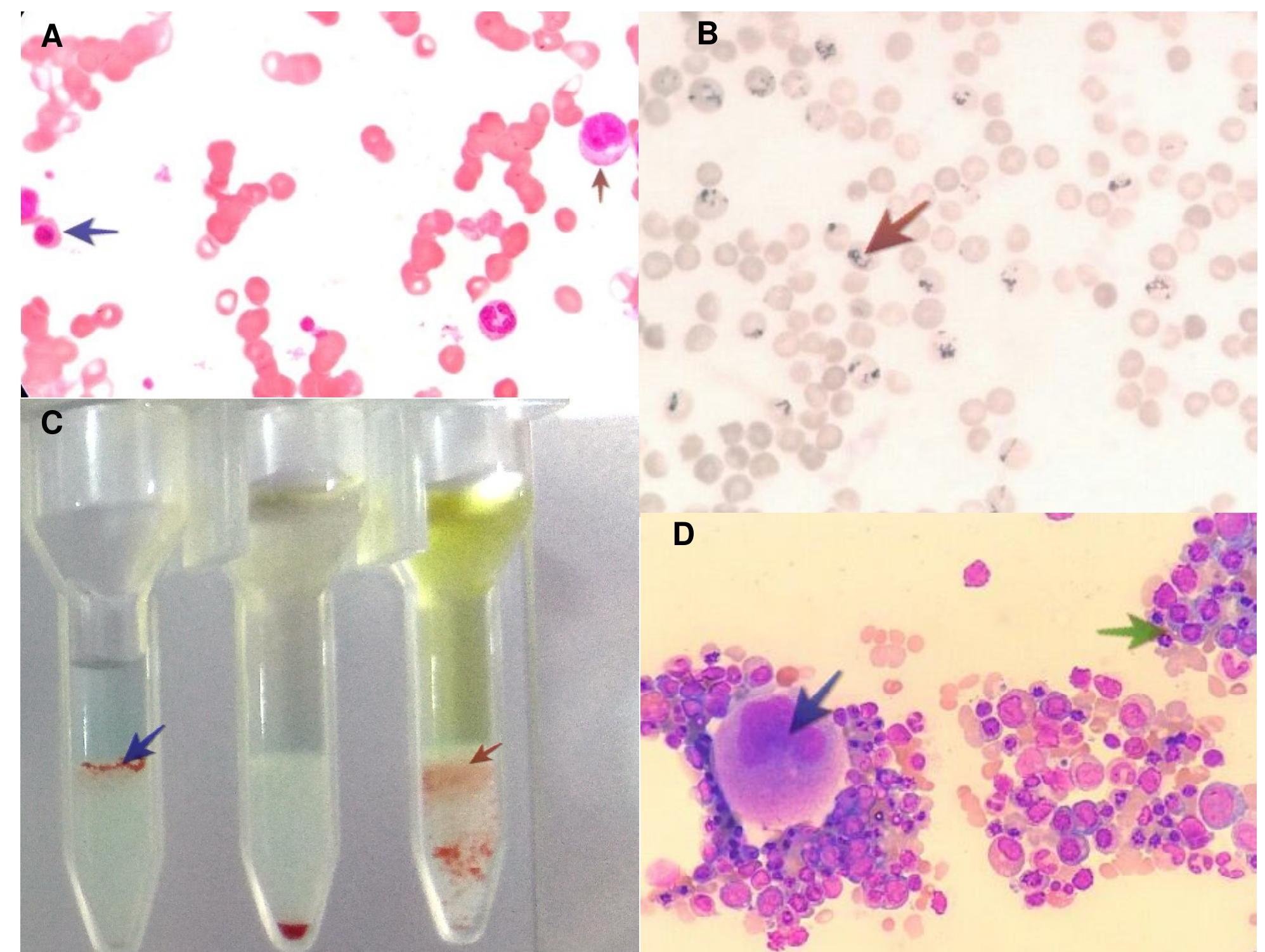 1; photomicrograph of peripheral blood smear showing