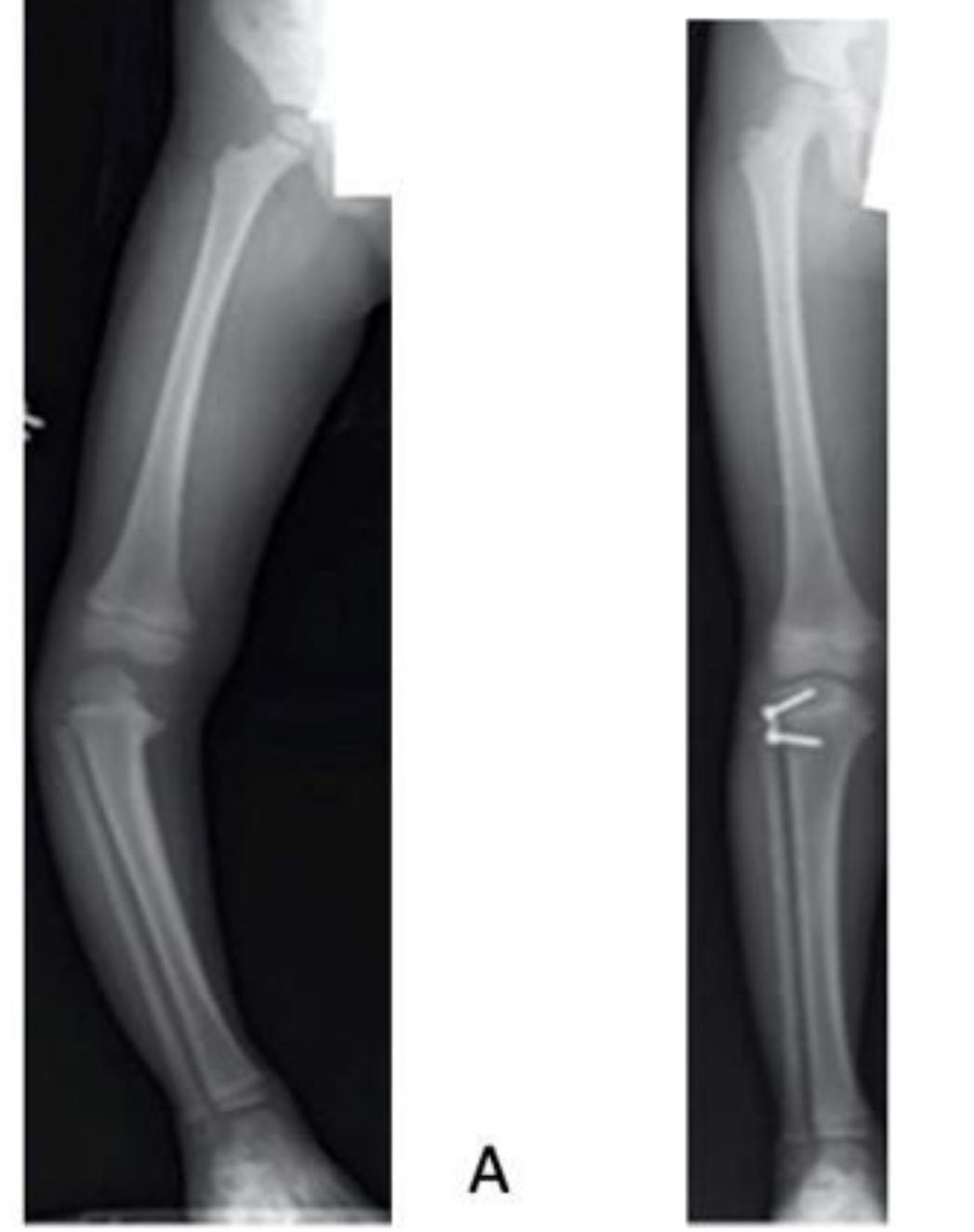 Figure 1 - Guided Growth Vs. Tibial Osteotomy in Early Stage