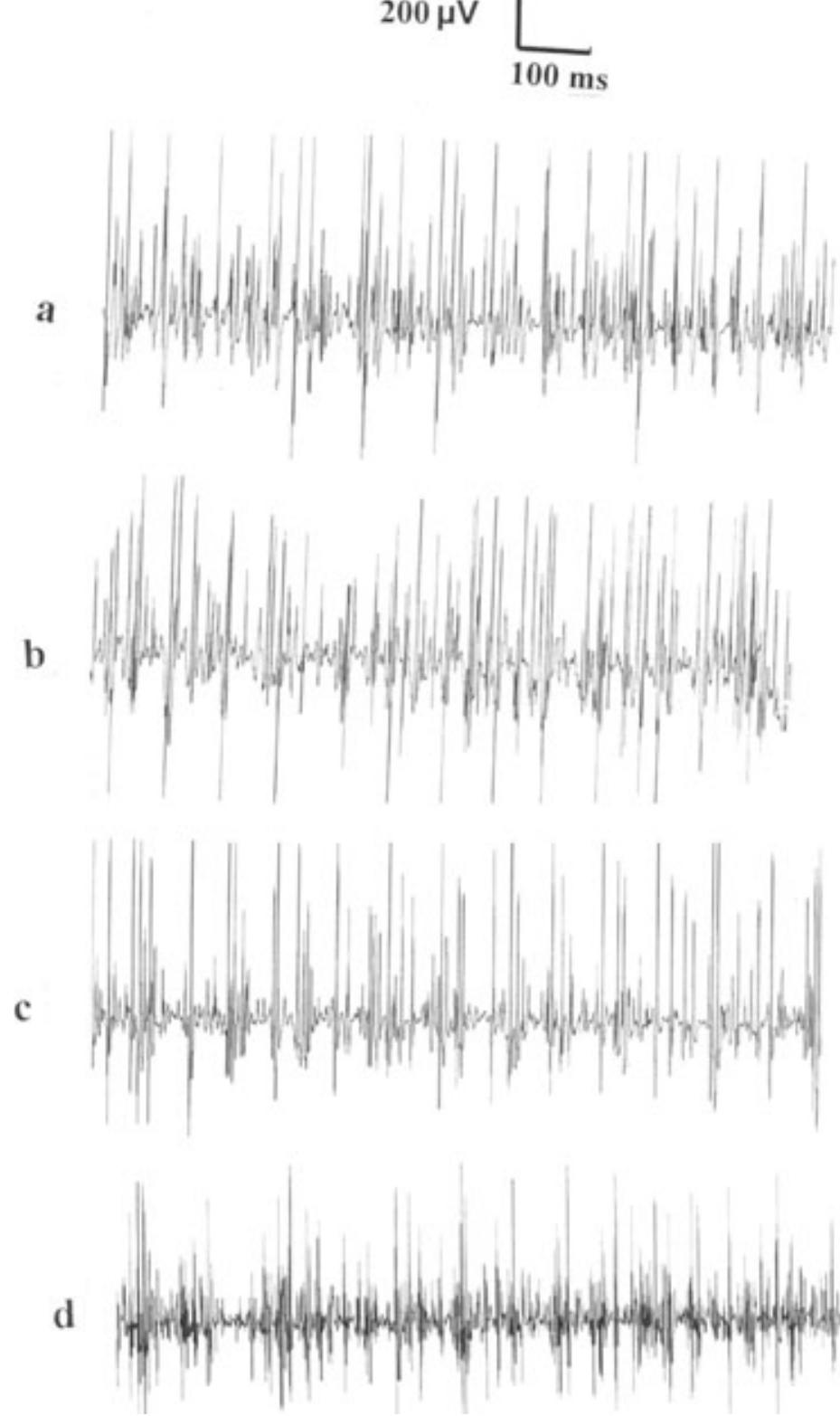 The emg activity of the anterior abdominal wall muscles at