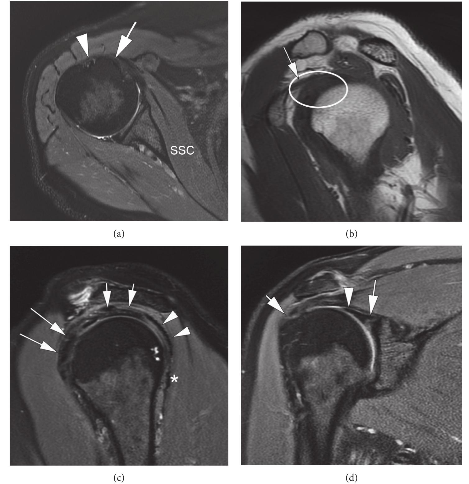 Normal mri of the right shoulder. axial t2-weighted