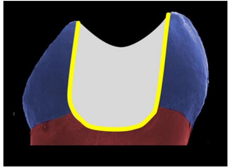 Ceramic inlay (white) luted with resin composite (yellow) in