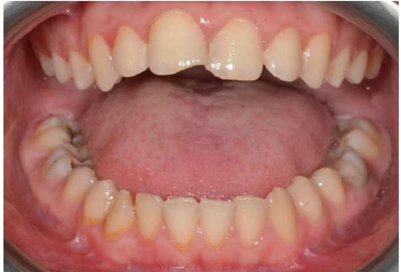 Inflammatory signs of the free gingival margin and